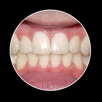 Bite Correction Explained