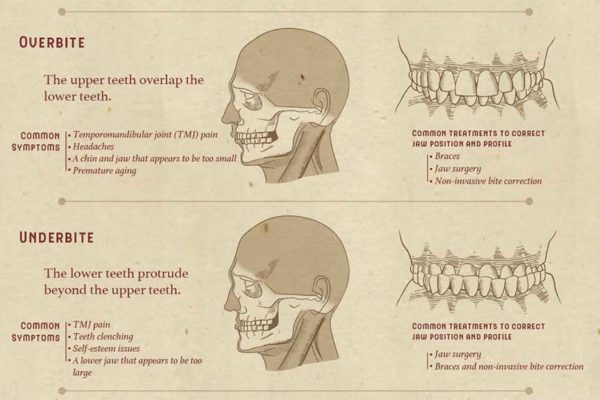 Malocclusion: Types, Symptoms, and Causes