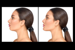 Small Chins: Causes and Treatment Options to Consider - Bite Correction